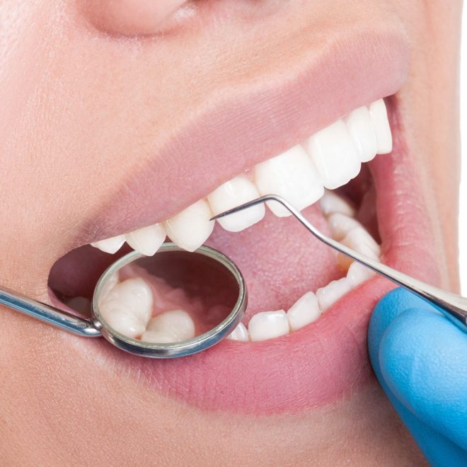 Diş Taşı Nedir? Neden Oluşur? - Çorum DişçiÇorum Dişçi